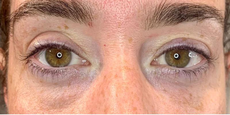 Lumi Eyes Treatment In Heathfield | Radiant Facial Rejuvenation