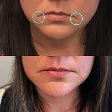 Lower Face Botox | Expert Anti-Aging Solutions